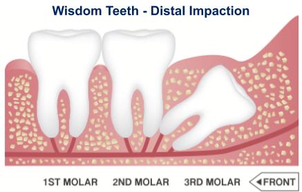 Impacted Wisdom Teeth | Oral & Maxillofacial Surgeon | Toowoomba