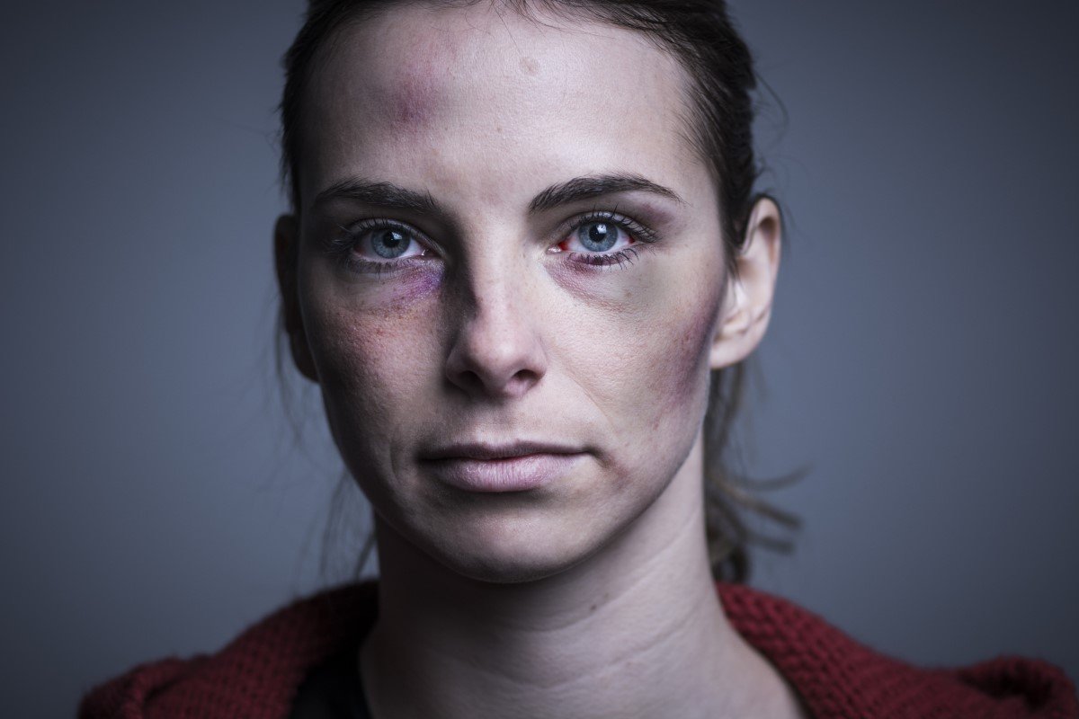 Facial Injuries, Oral & Maxillofacial Surgeon Toowoomba