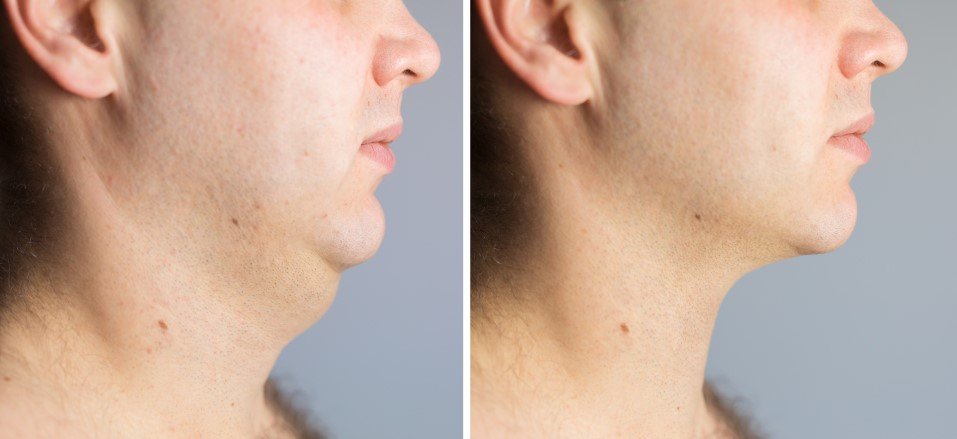 Neck Lift | Cosmetic Surgeon | Toowoomba
