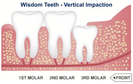 Wisdom Teeth Removal | Oral & Maxillofacial Surgeon | Toowoomba