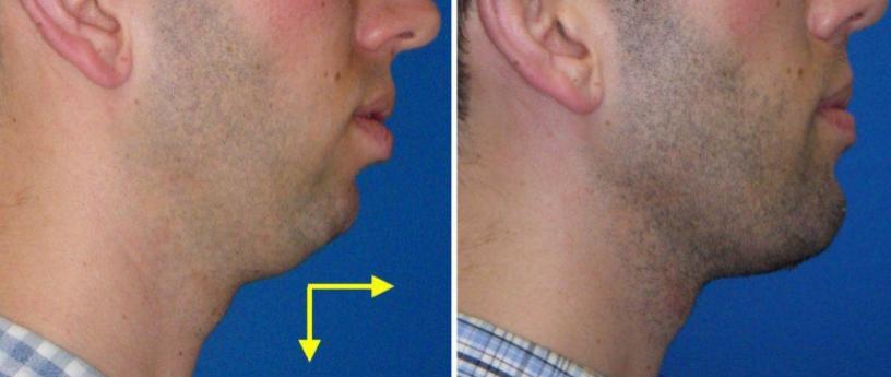 Genioplasty (Chin Surgery) | Cosmetic Surgeon | Toowoomba