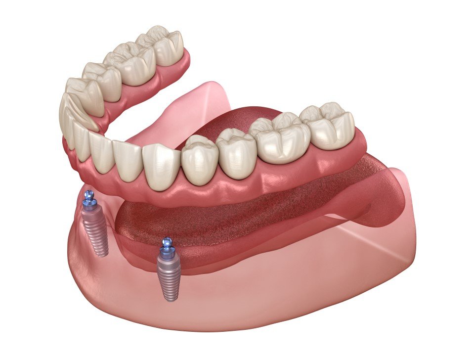 Overdenture | Oral & Maxillofacial Surgeon | Toowoomba