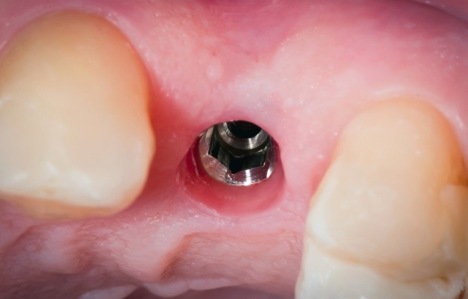 Soft Tissue Grafting | Oral & Maxillofacial Surgeon | Toowoomba