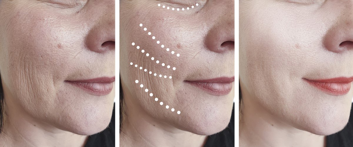 Cheek Lift | Cosmetic Surgeon | Toowoomba