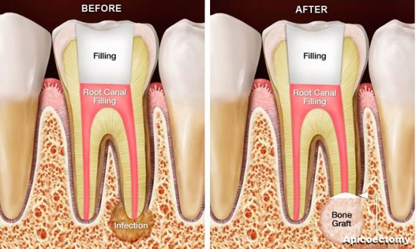 Roman Dental Arts - Hackensack, NJ - Endodontics