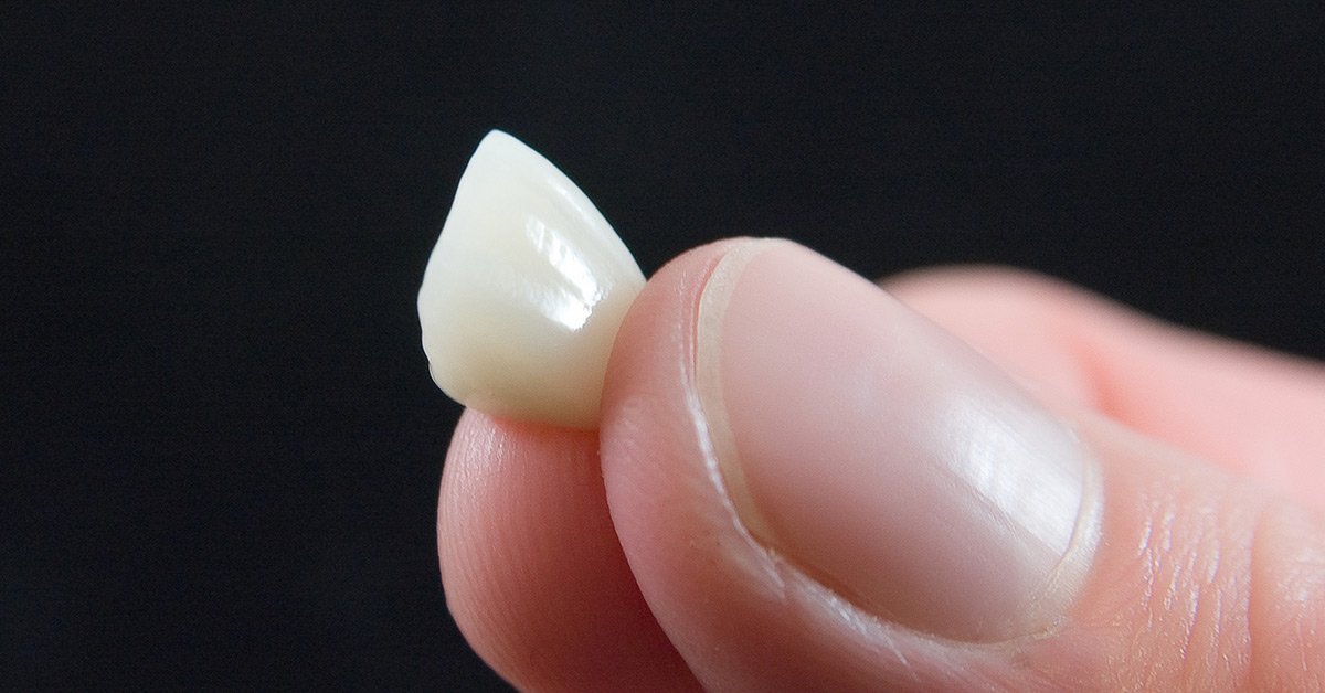 Getting Porcelain Crowns: Dental Crowns Explained and Compared