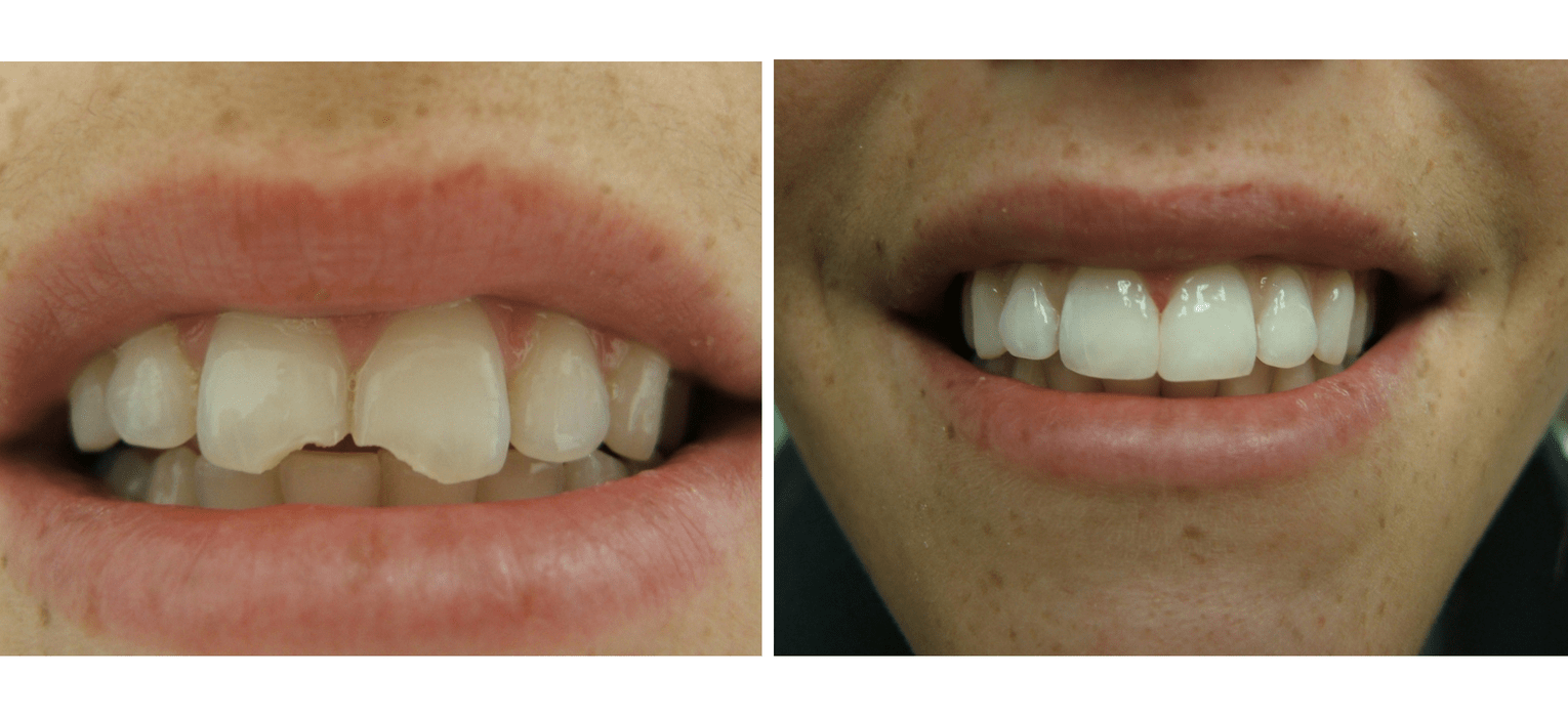 Before & After Smiles | Glen Allen, Va | Dr. Babik & Associates
