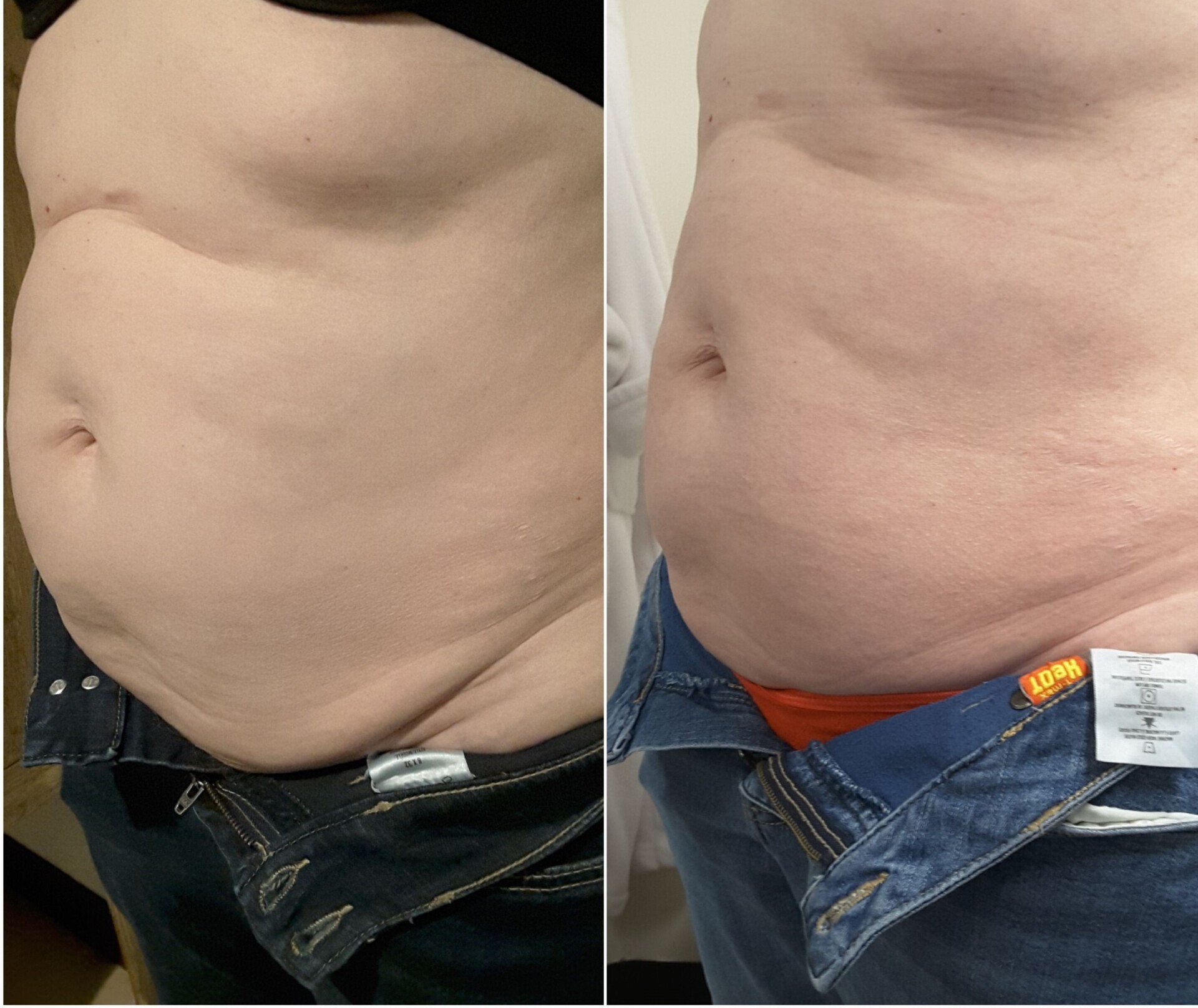 Before and After Results | Starz Laser