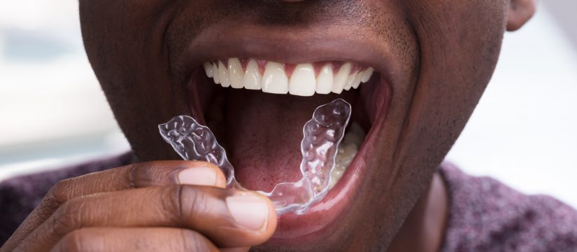The Pros and Cons of Invisalign® | Blue Ashe Dental