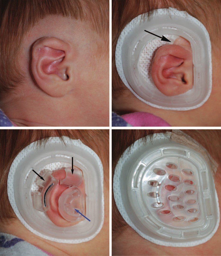 Ear Malformations