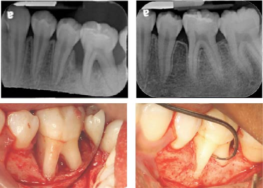 Treatment of Periodontal Disease | Orchard Park Periodontics