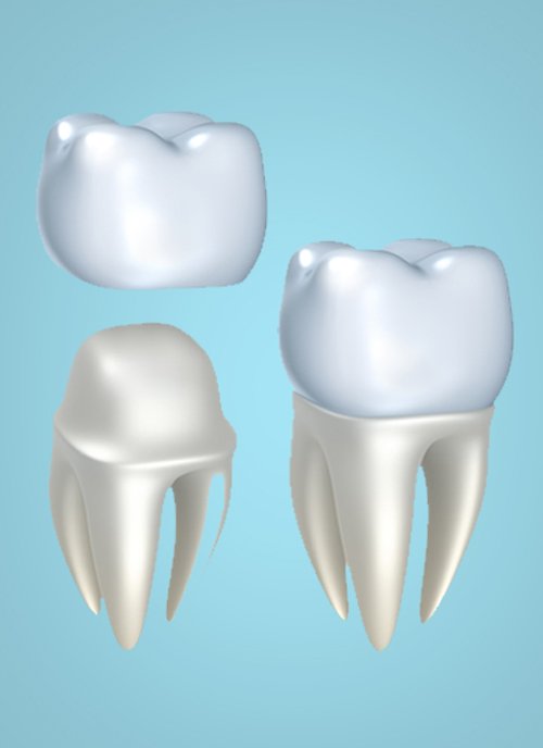 Tannkrone – et godt alternativ til tannfylling | Clear