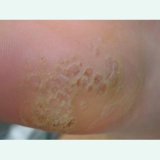 Verruche - Bologna - Tommasini Dr. Tiberio podologo