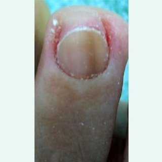 Verruche - Bologna - Tommasini Dr. Tiberio podologo