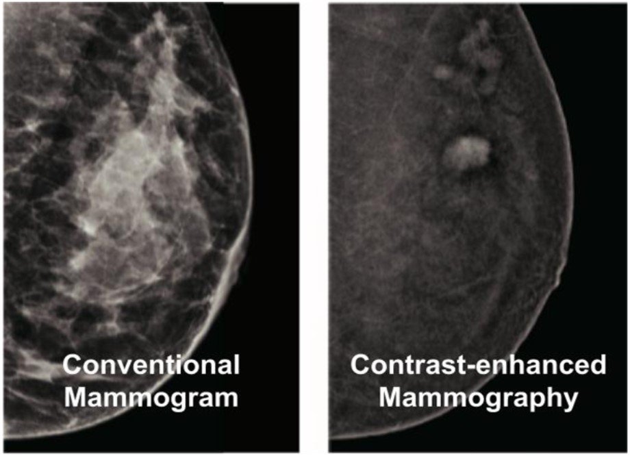 Contrast Enhanced Mammography | Breast Imaging Victoria