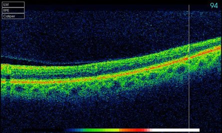 OCT eye scans from Penny & Hayter Opticians