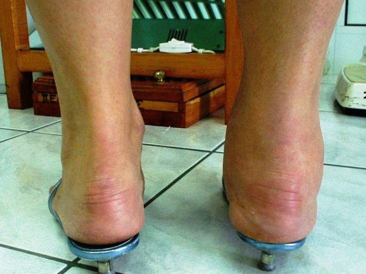 What to Know About Steroid Injections for Pain