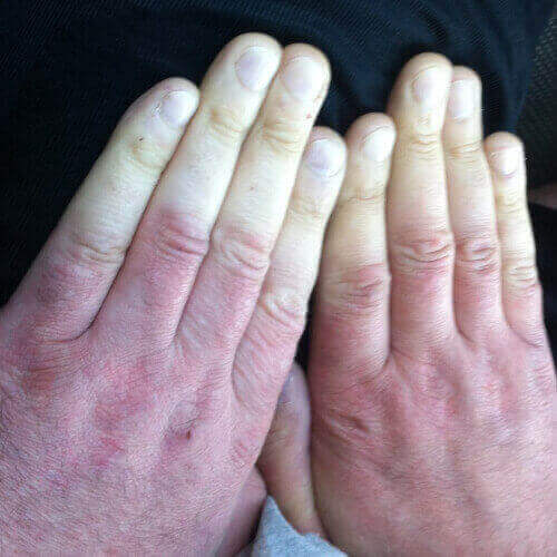 Spot these Signs of Hand-Arm Vibration Syndrome