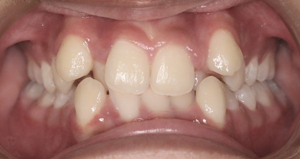 Crowding Teeth in Doncaster | E Orthodontics
