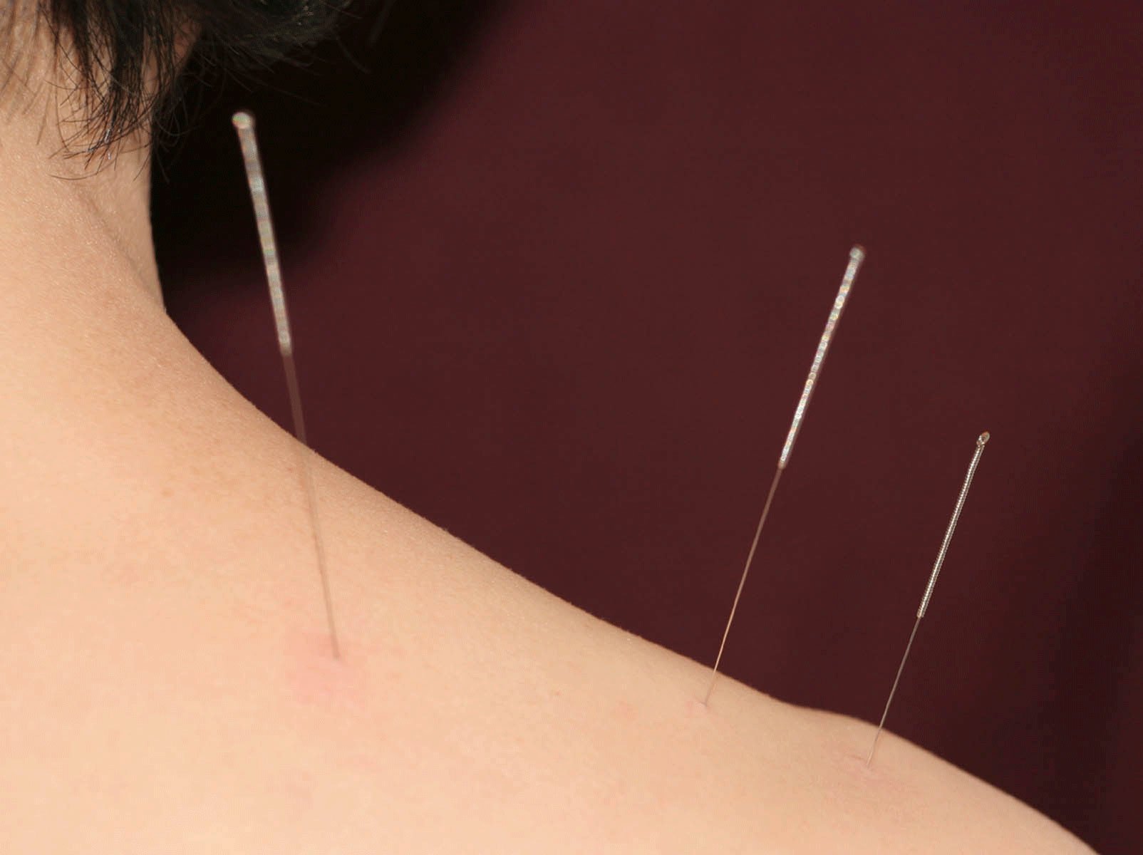 Acupuncture Services in Springfield | Orion Family Physiotherapy