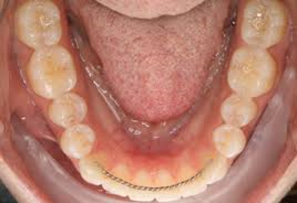 Fixed lingual retainers | St.Albert Orthodontists