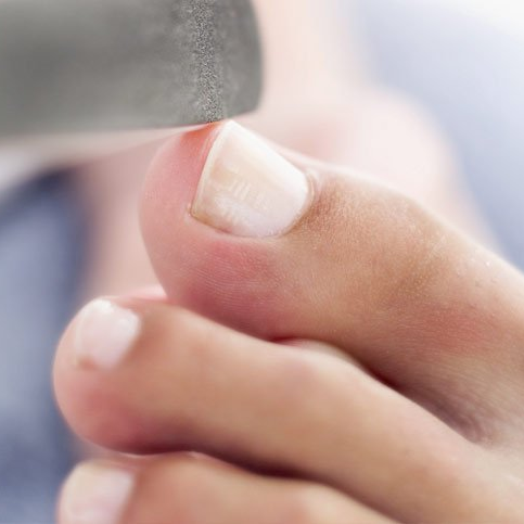 Diabetic Foot Care in Sandgate, Qld | Fiona Green Podiatry