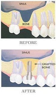 Restorative Dentistry | Prostho-Implants Dental Associates El Salvador