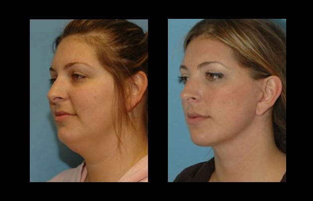 Face and Neck Lifting Mexico| Dr. Jorge Galvan
