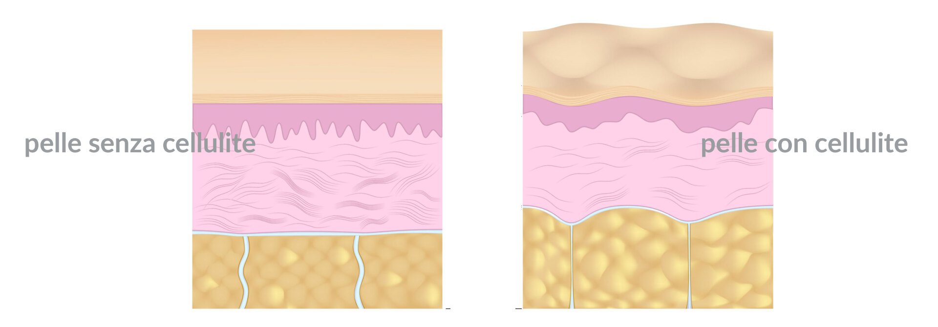 LA CELLULITE NON E' UN IN ESTETISMO E' UNA PATOLOGIA.