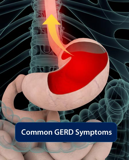 GERD Treatments NYC with Acupuncture by Marc Bystock L.Ac.