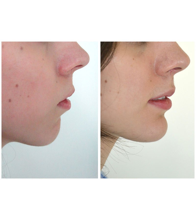 Cirugia de Menton en Guadalajara | Mentoplastia | Dr. Barron