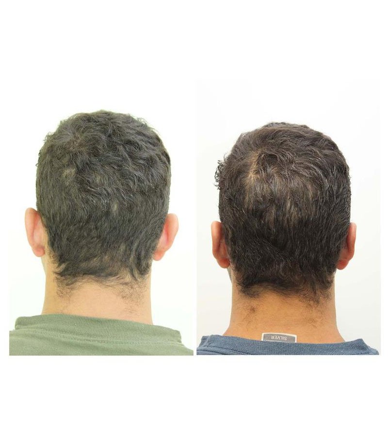 Cirugia de Orejas en Guadalajara | Otoplastia | Dr. Barron