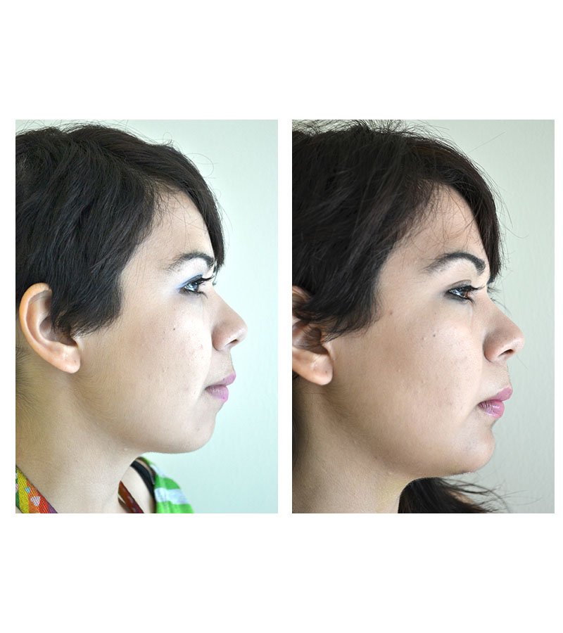 Cirugia de Menton en Guadalajara | Mentoplastia | Dr. Barron