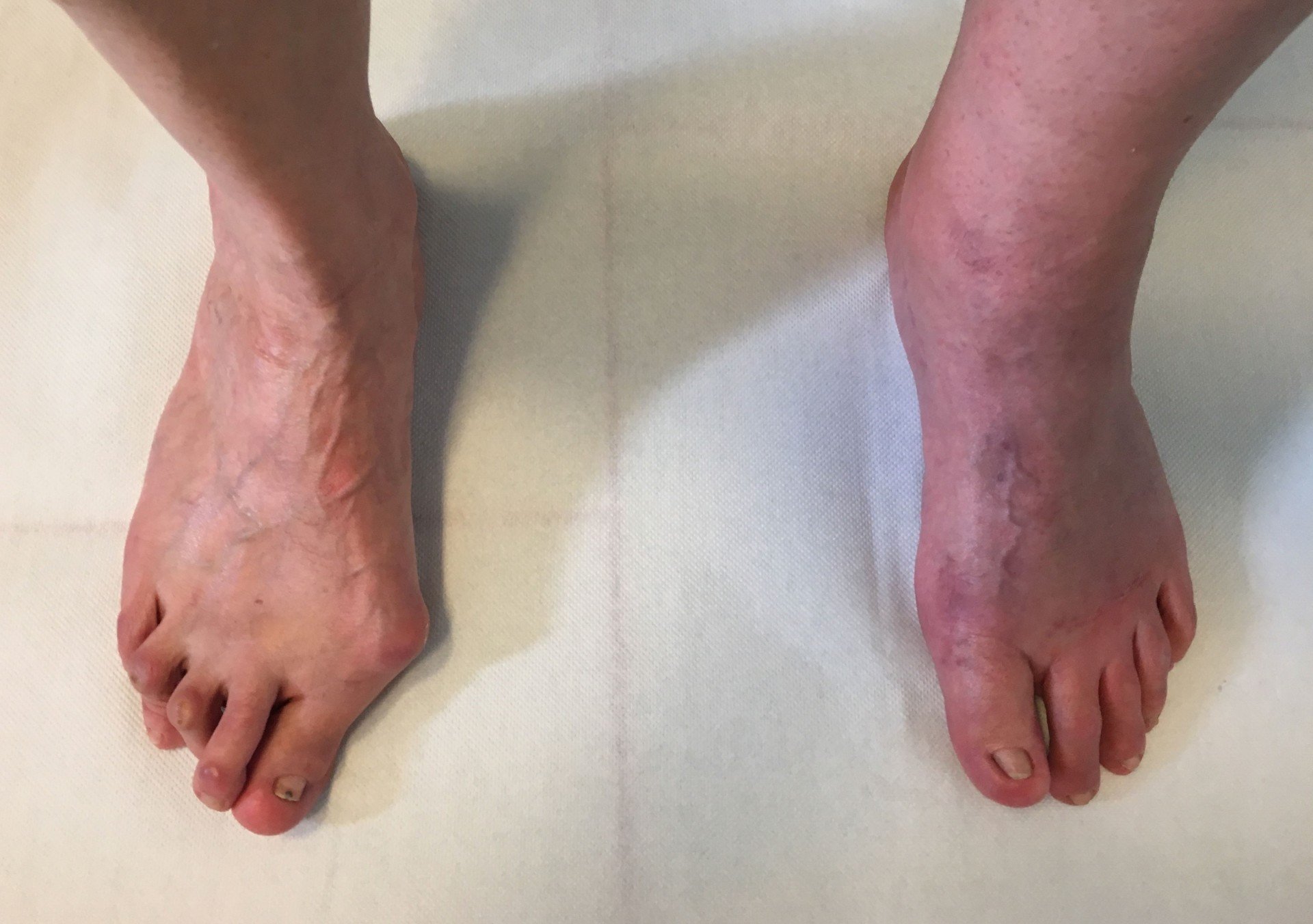 Chirurgia piede anteriore - Bologna - Dr. Roberto Bevoni