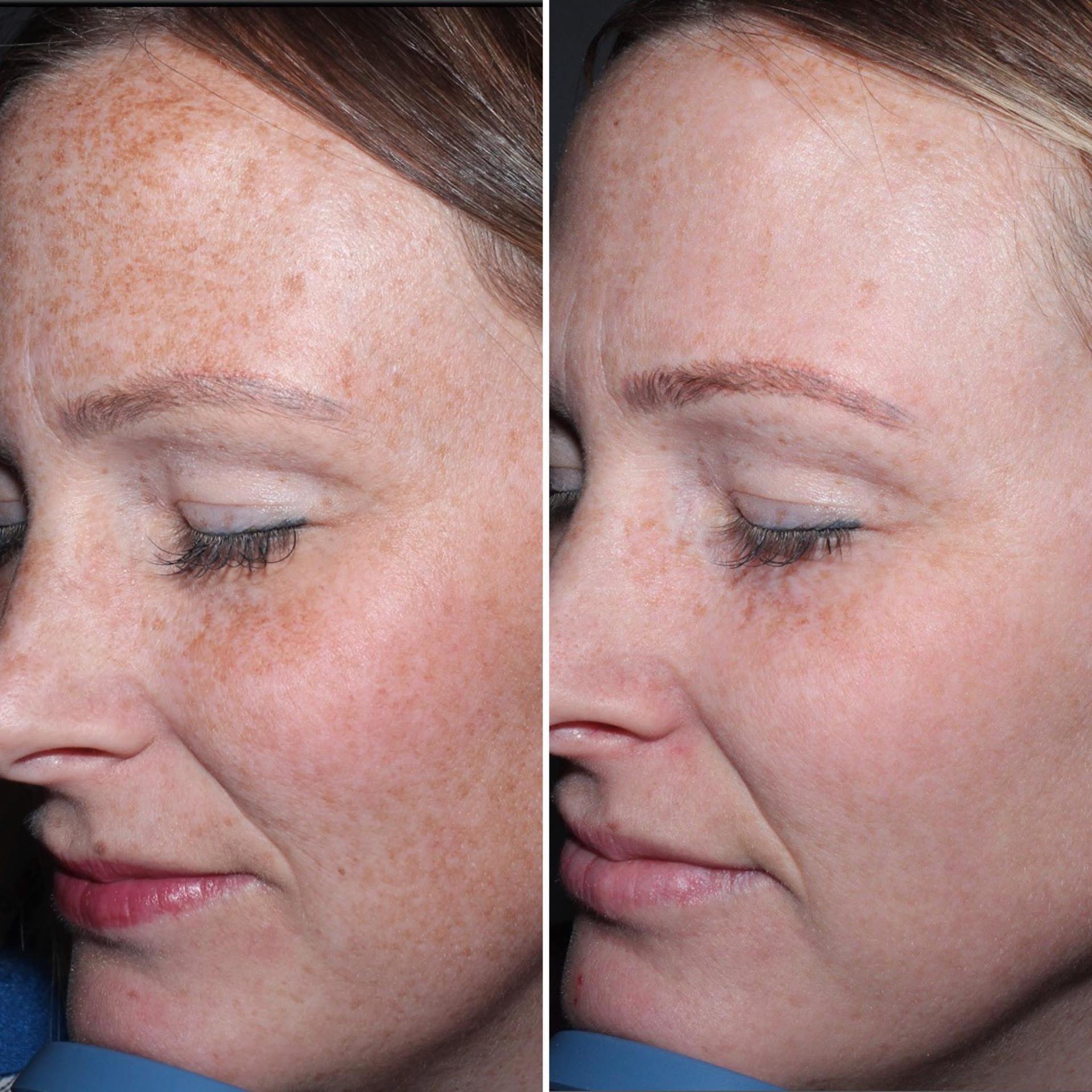 MedSpa Before & After Gallery | MedSpa Treatments Photo Gallery ...