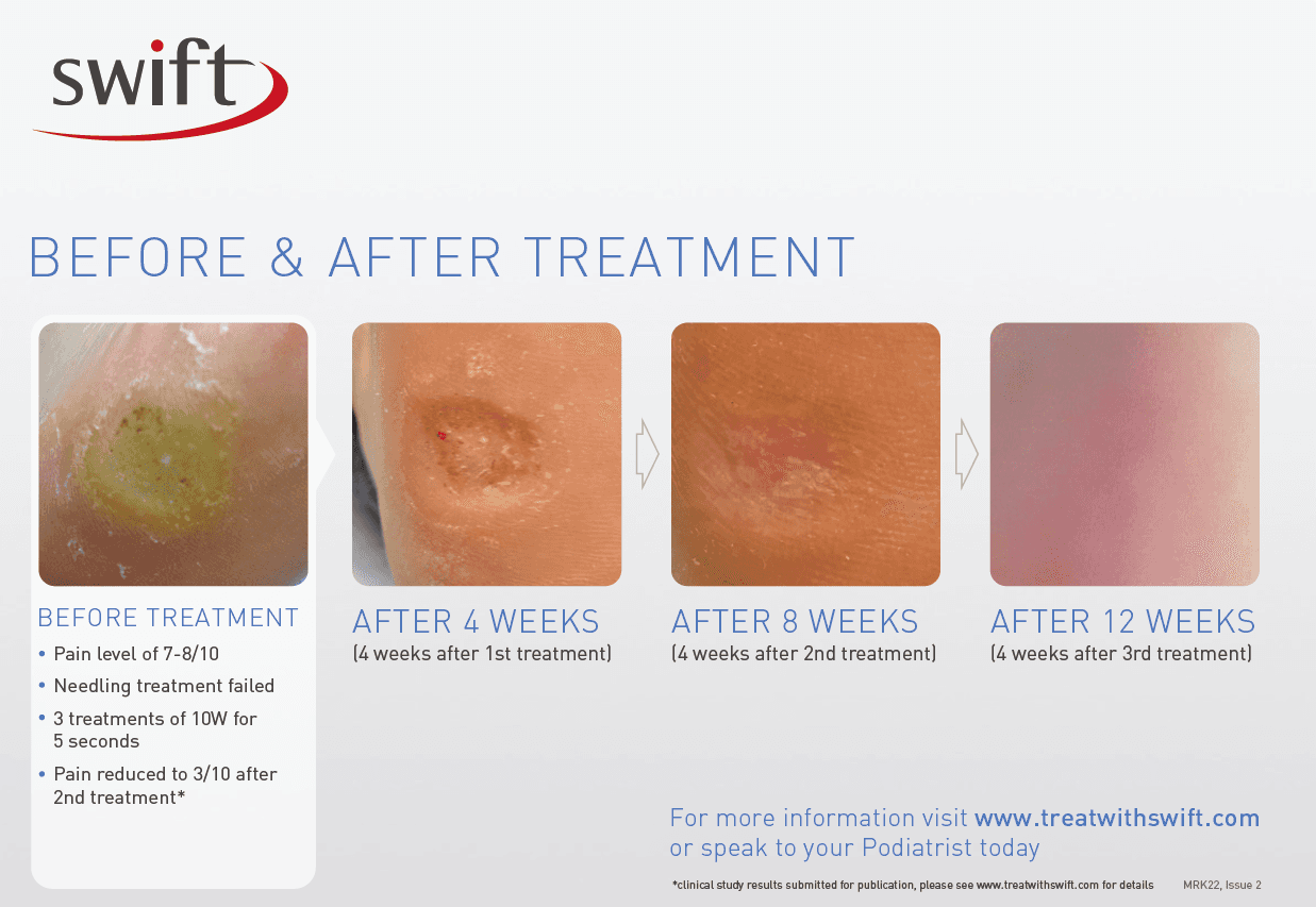 Swift microwave verruca treatment in Lurgan, Craigavon, Northern Ireland