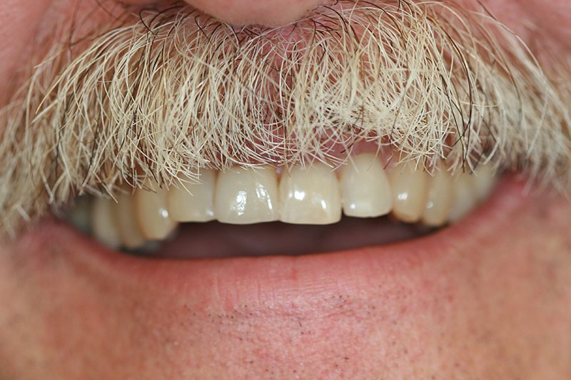 Implants | Rogers, AR | Ozark Comprehensive Dentistry