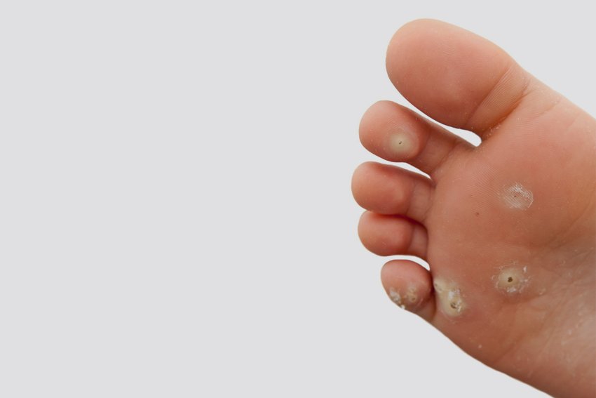 Verruca treatment and surgery | Tile Hill Footcare & Podiatry