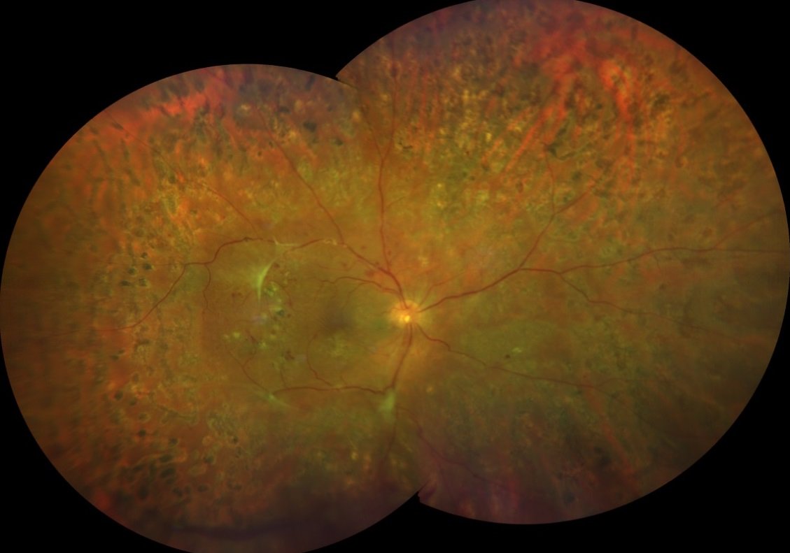 Diabetic Retinopathy | Southside Eye Centre