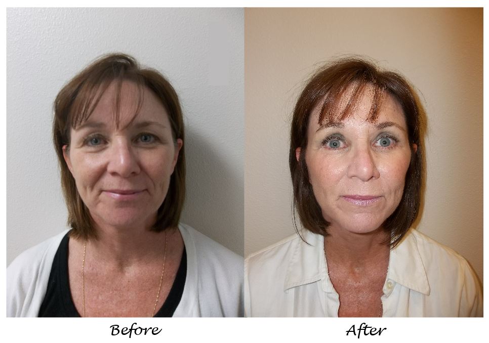 Lower Facelift in Orlando FL
