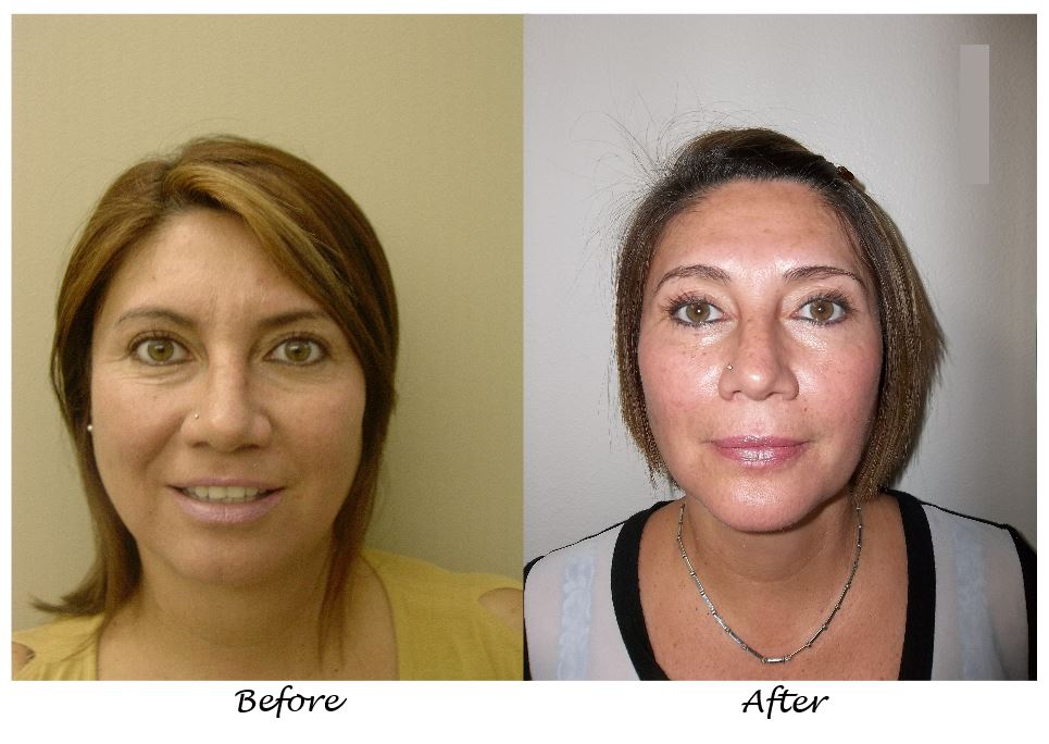 Lower Facelift in Orlando FL