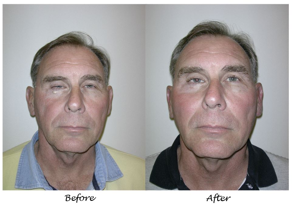 Lower Facelift in Orlando FL