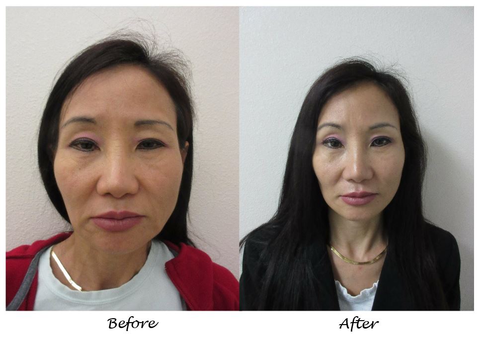 Lower Facelift in Orlando FL