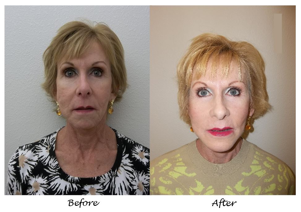 Lower Facelift in Orlando FL
