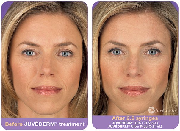 Allergan Fillers | SpaMD | Wichita KS