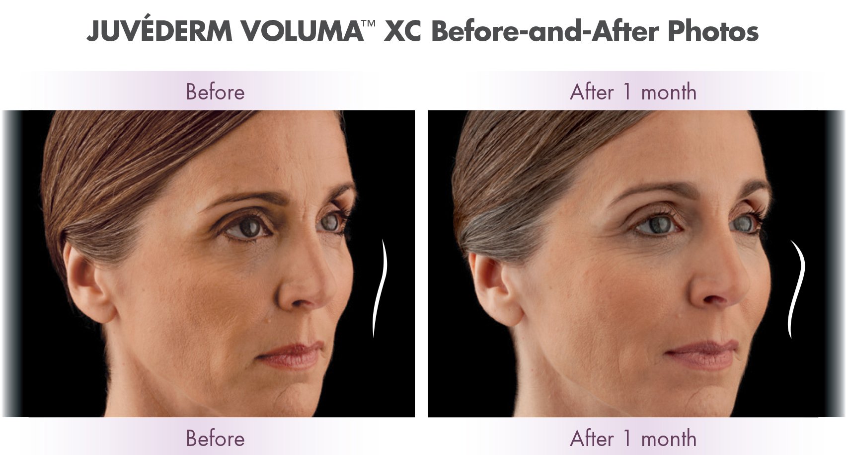 Allergan Fillers | SpaMD | Wichita KS