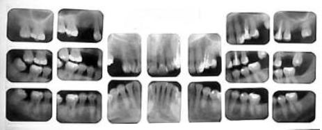 Dental X-ray Service In Syracuse, NY | Smiles By Design