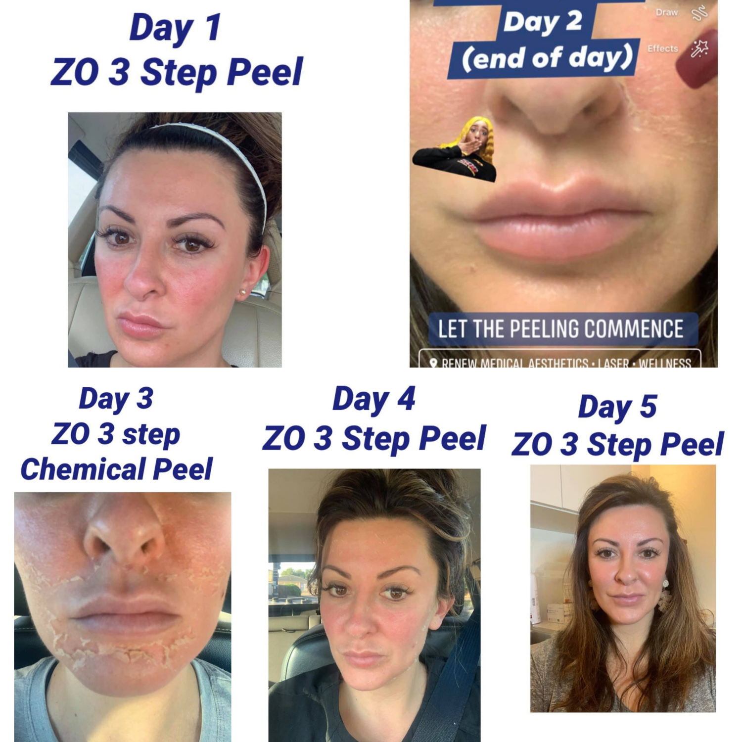 Chemical Peels | Everything You Need to Know