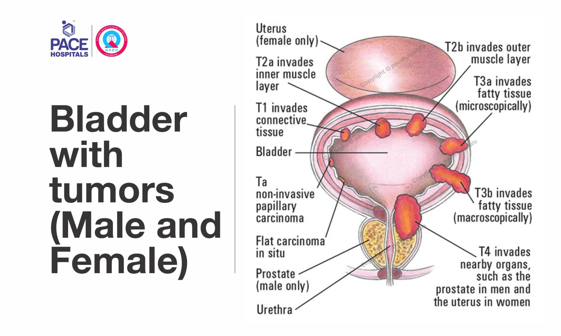 Bladder Problems After Colon Resection At Makayla Moffatt Blog