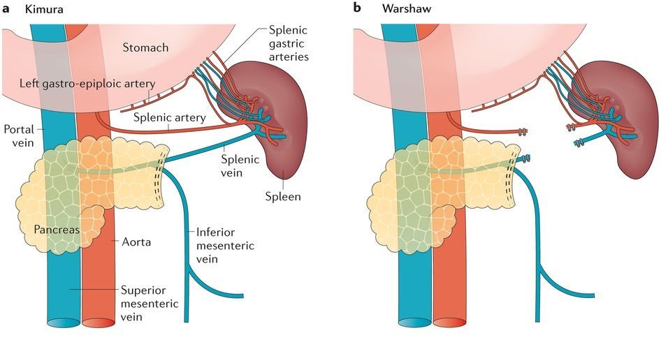 Laparoscopic distal panceatectomy (pancreas) with spleen preservation